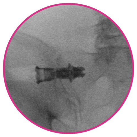 Liberty SI - Spinal Simplicity