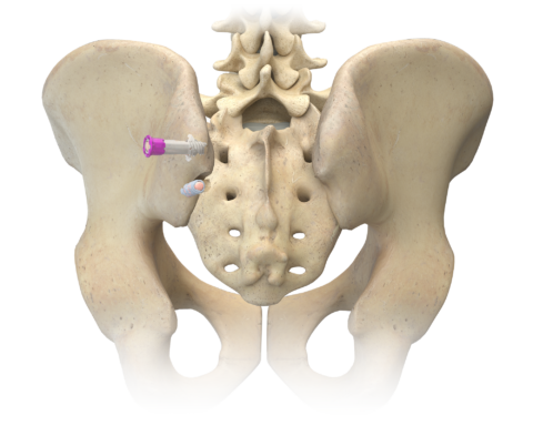 Hero SI - Spinal Simplicity