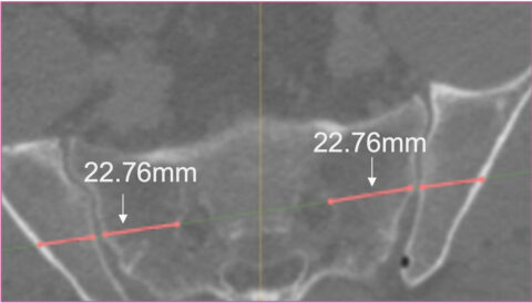 Liberty SI - Spinal Simplicity